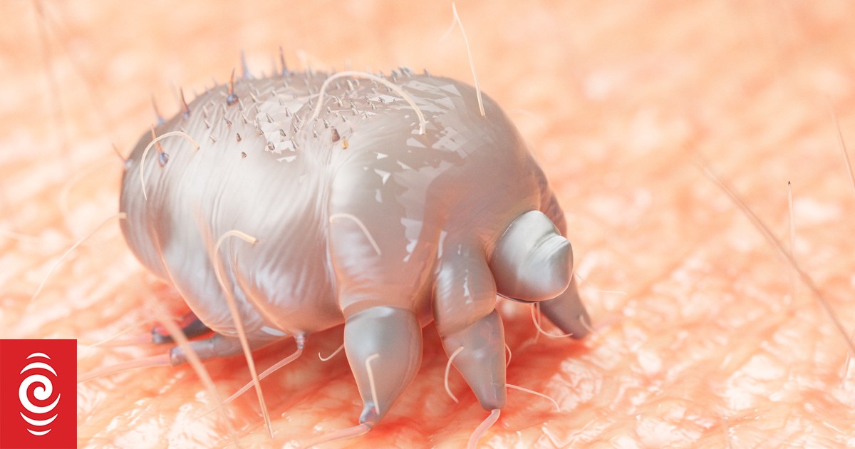 Scabies becoming entrenched in Dunedin - Doctor | RNZ