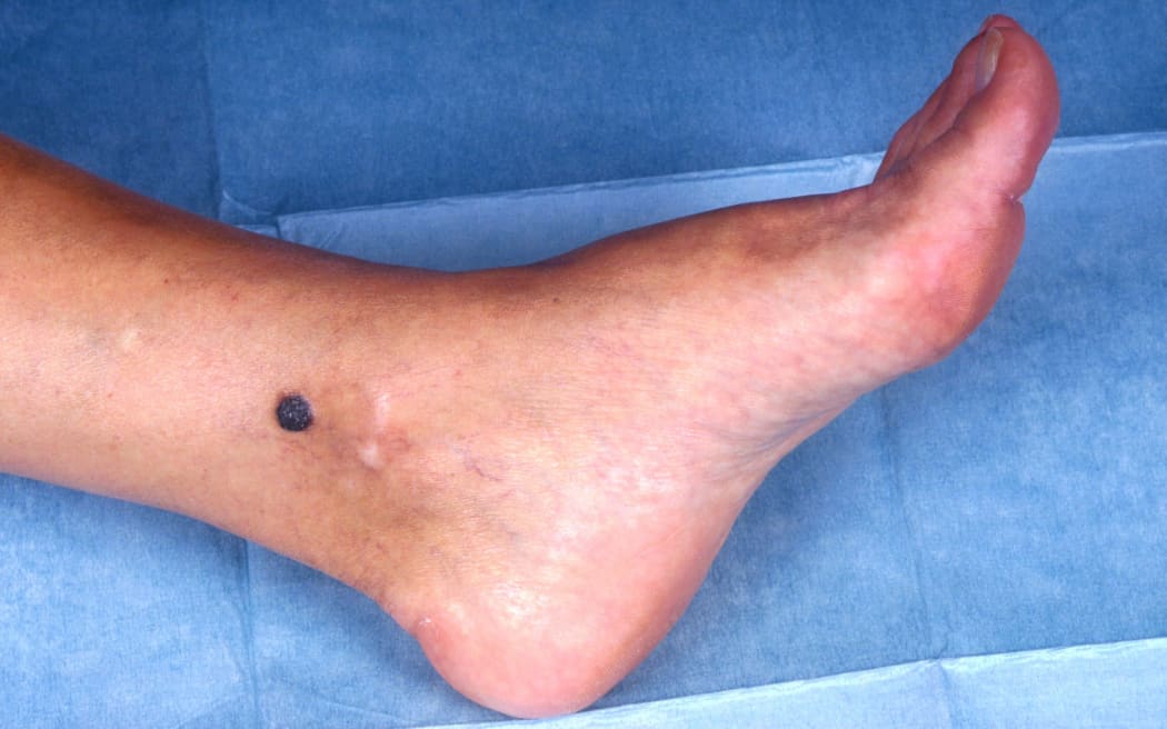 Right Arm Moles Flag Melanoma Risk Rnz News