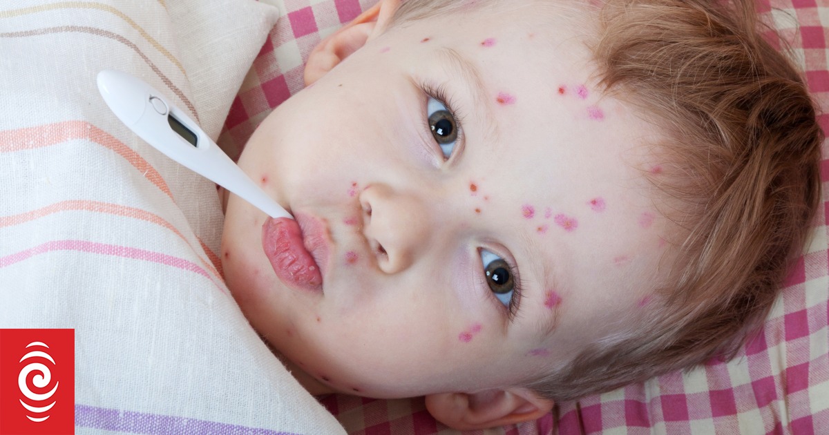 Chickenpox outbreak in US city with big anti-vaccine community | RNZ News