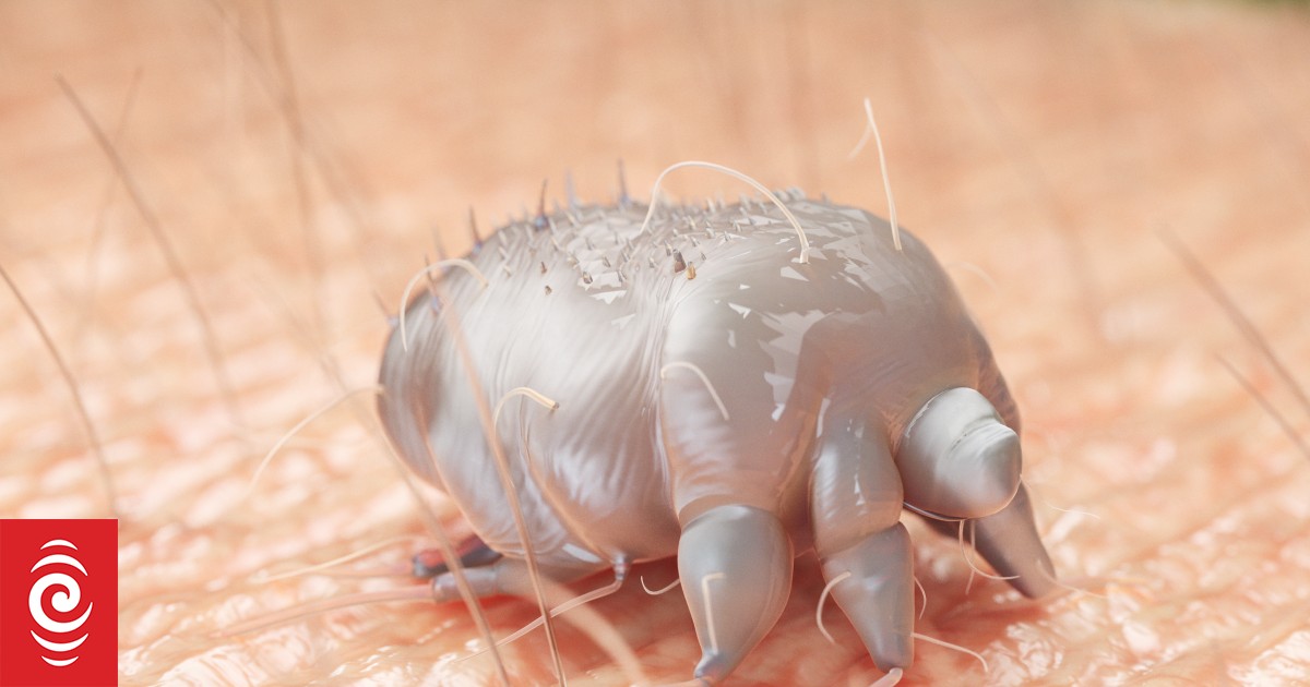 Scabies cases on rise amongst student populations but treatment access ...